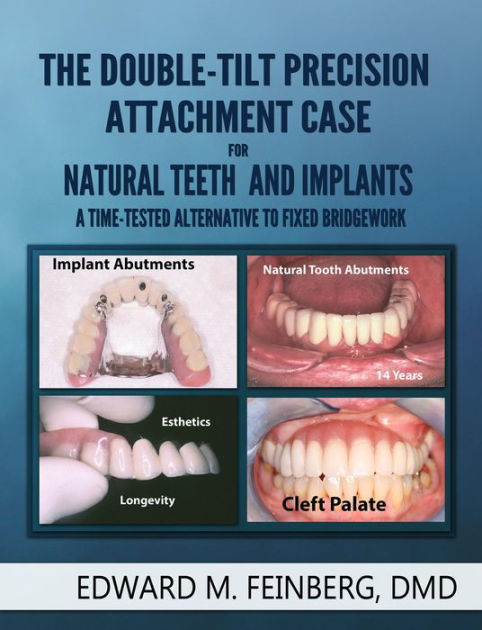 The Double-Tilt Precision Attachment Case for Natural Teeth and ...