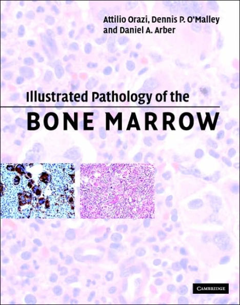 Illustrated Pathology of the Bone Marrow by Attilio Orazi, Dennis P. O'Malley, Daniel A. Arber ...