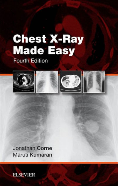 Chest X-Ray Made Easy E-Book: Chest X-Ray Made Easy E-Book by Jonathan ...