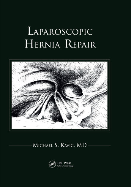 Laparoscopic Hernia Repair by Michael S Kavic | eBook | Barnes & Noble®