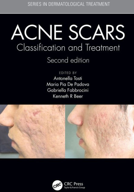 Acne Scars: Classification and Treatment, Second Edition by Antonell ...