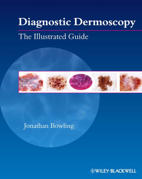 Diagnostic Dermoscopy: The Illustrated Guide by Jonathan Bowling ...
