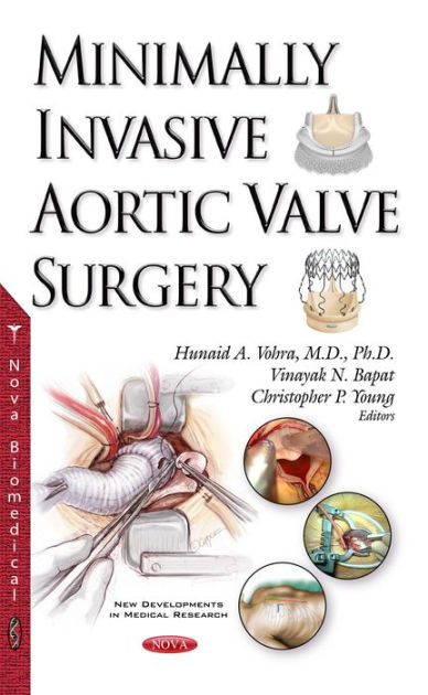 Minimally Invasive Aortic Valve Surgery by Hunaid A. Vohra, Vinayak ...