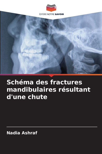 Schï¿½ma des fractures mandibulaires rï¿½sultant d'une chute by Nadia ...
